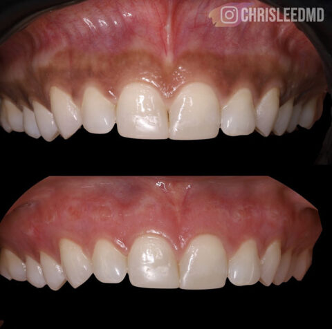 Dental Crown in New Westminster | Tooth Crown Near You